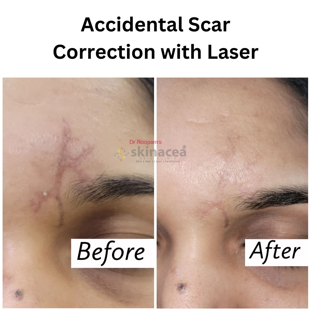 Laser Resurfacing | Skinacea Skin Clinic